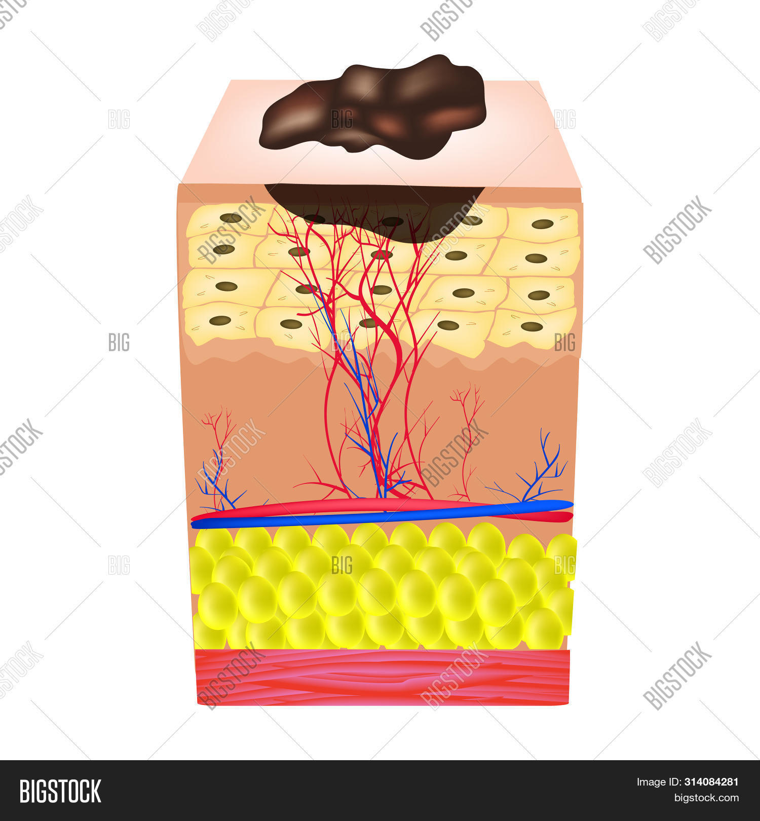 The Structure Of The Nevus. The Structure Of Moles On The Skin ...