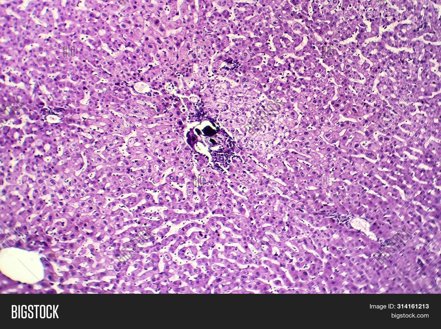 Liver Schistosomiasis, Light Micrograph, Photo Under Microscope Showing ...