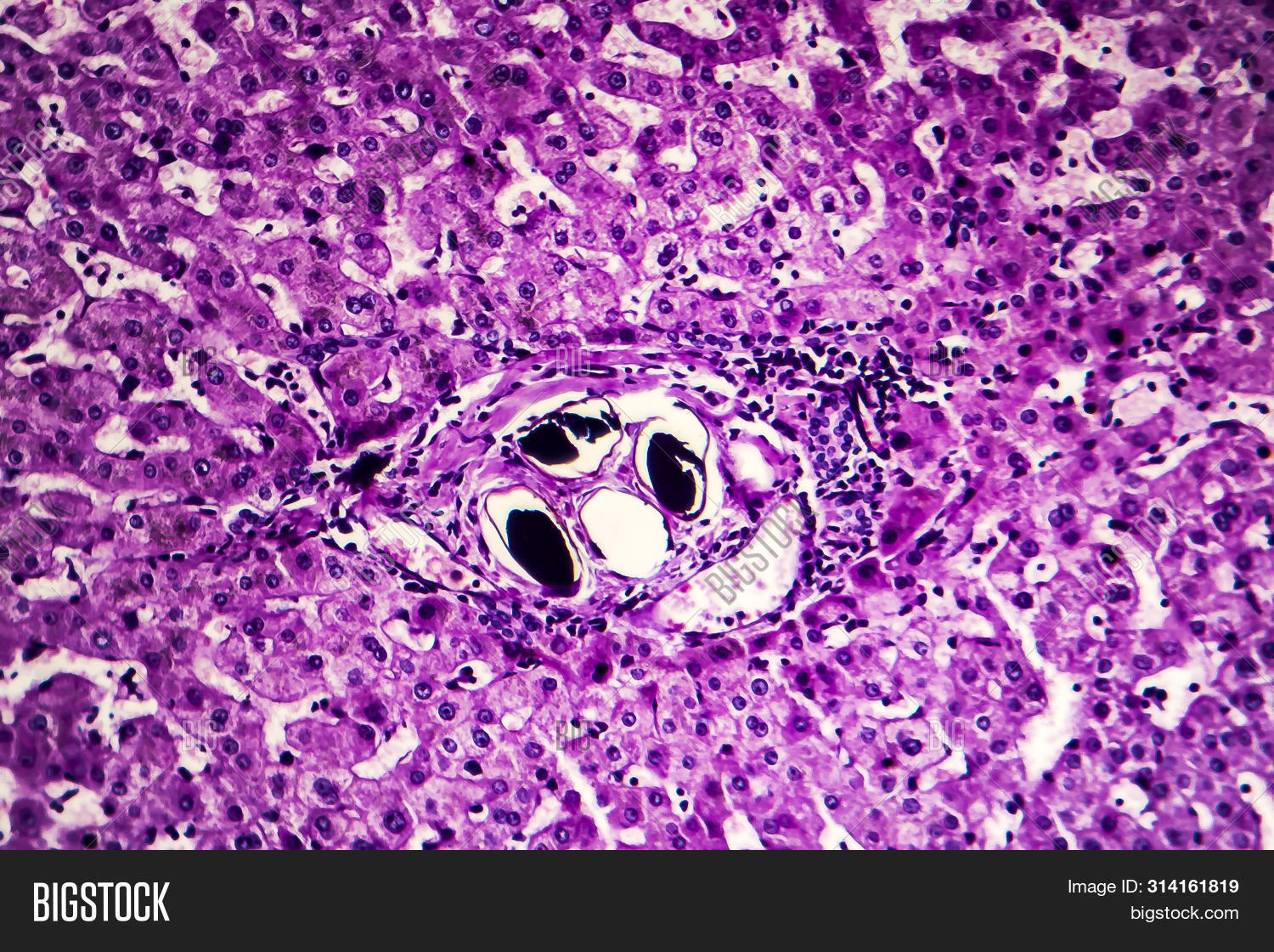 Liver Schistosomiasis, Light Micrograph, Photo Under Microscope Showing ...