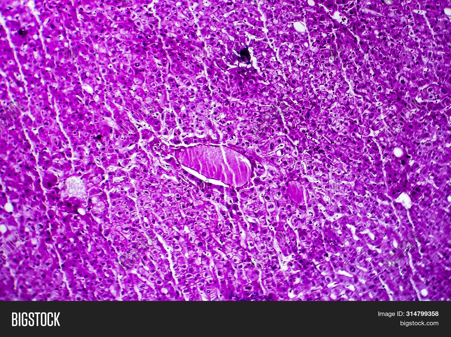 Liver Edema, Light Micrograph, Photo Under Microscope image & stock ...