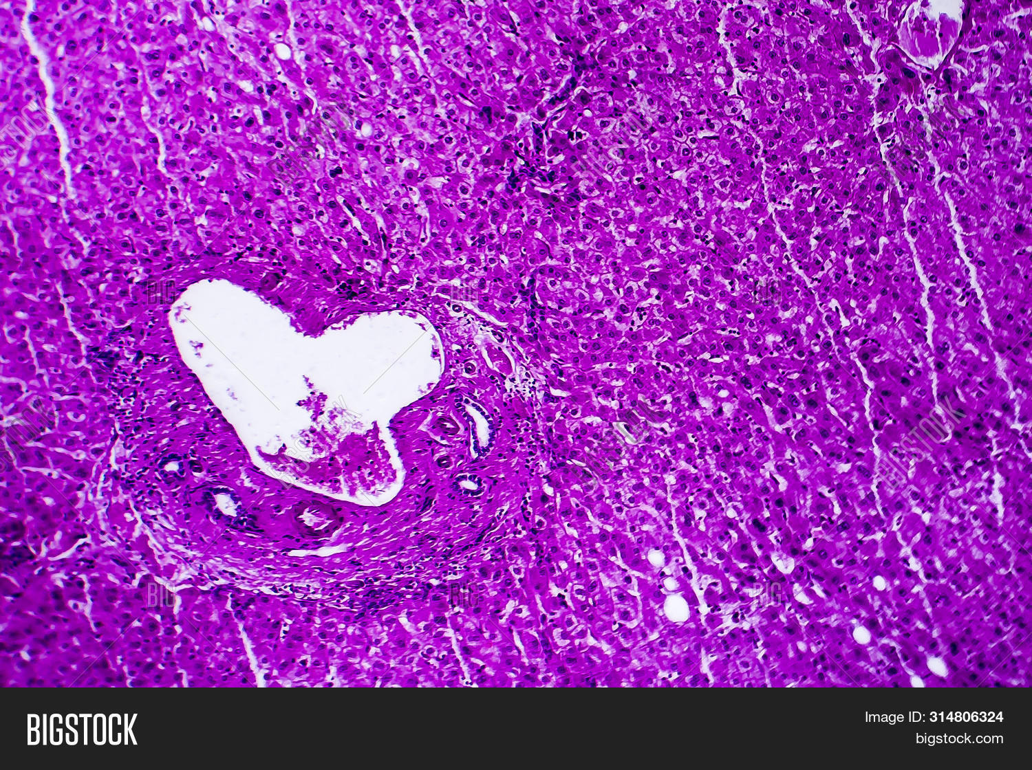 Liver Edema, Light Micrograph, Photo Under Microscope image & stock ...