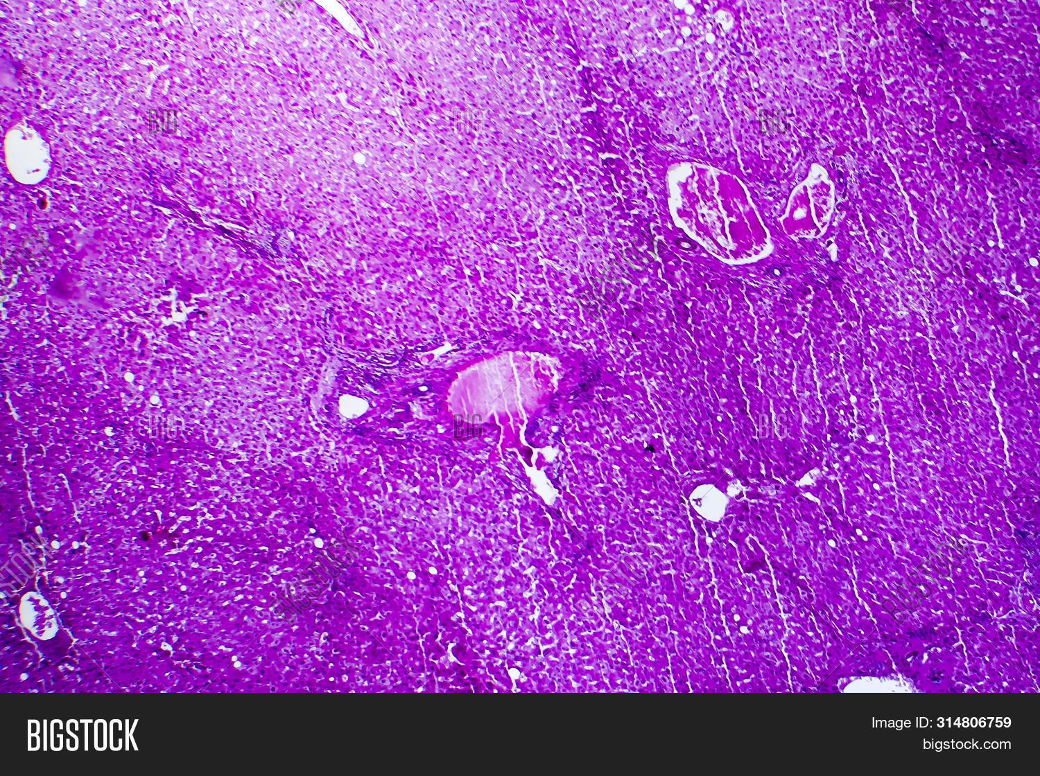 Liver Edema, Light Micrograph, Photo Under Microscope image & stock ...