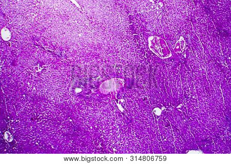 Liver Edema, Light Micrograph, Photo Under Microscope image & stock ...