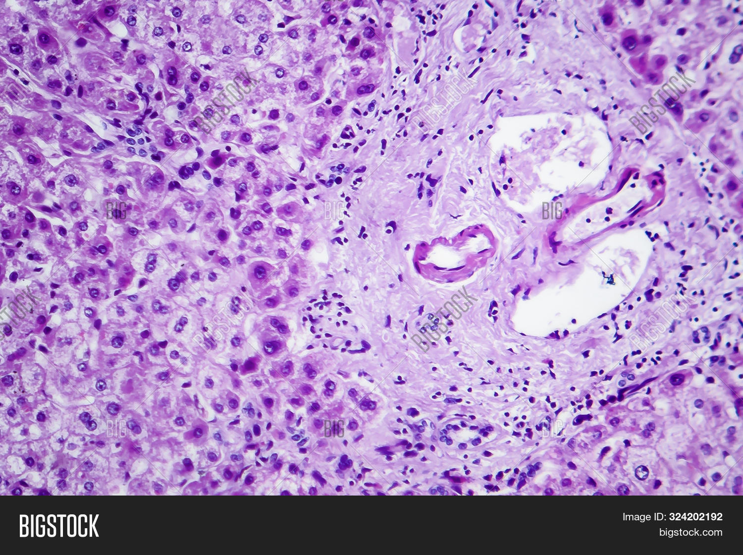 Cloudy Swelling Of The Liver, Light Micrograph, Photo Under Microscope ...