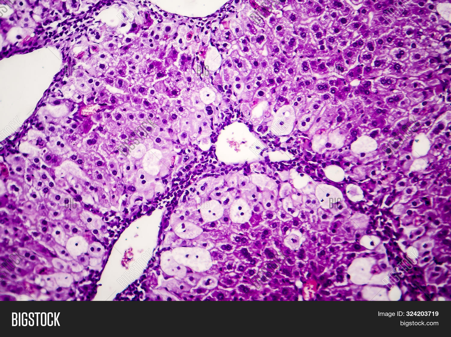 Histopathology Of Acute Hepatitis, Light Micrograph, Photo Under ...