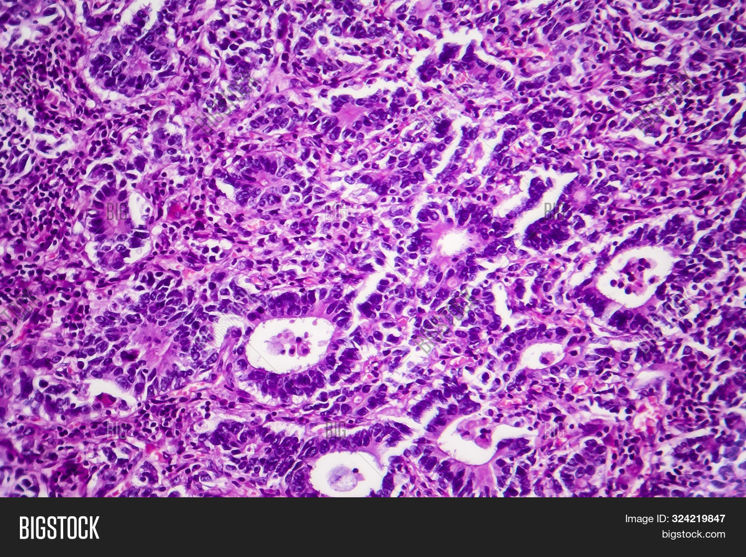 Gastric Adenocarcinoma, Light Micrograph, Photo Under Microscope image ...