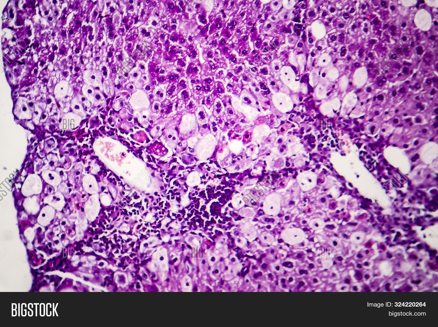 Histopathology Of Acute Hepatitis, Light Micrograph, Photo Under ...