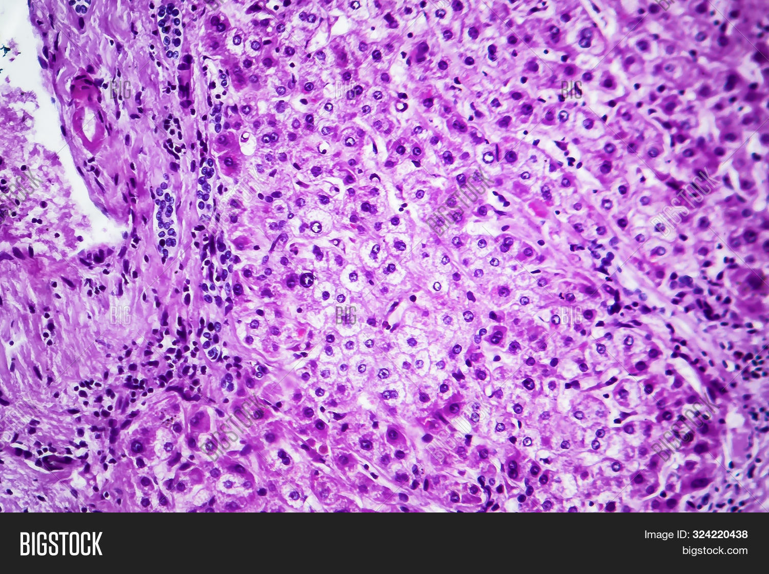 Cloudy Swelling Of The Liver, Light Micrograph, Photo Under Microscope ...