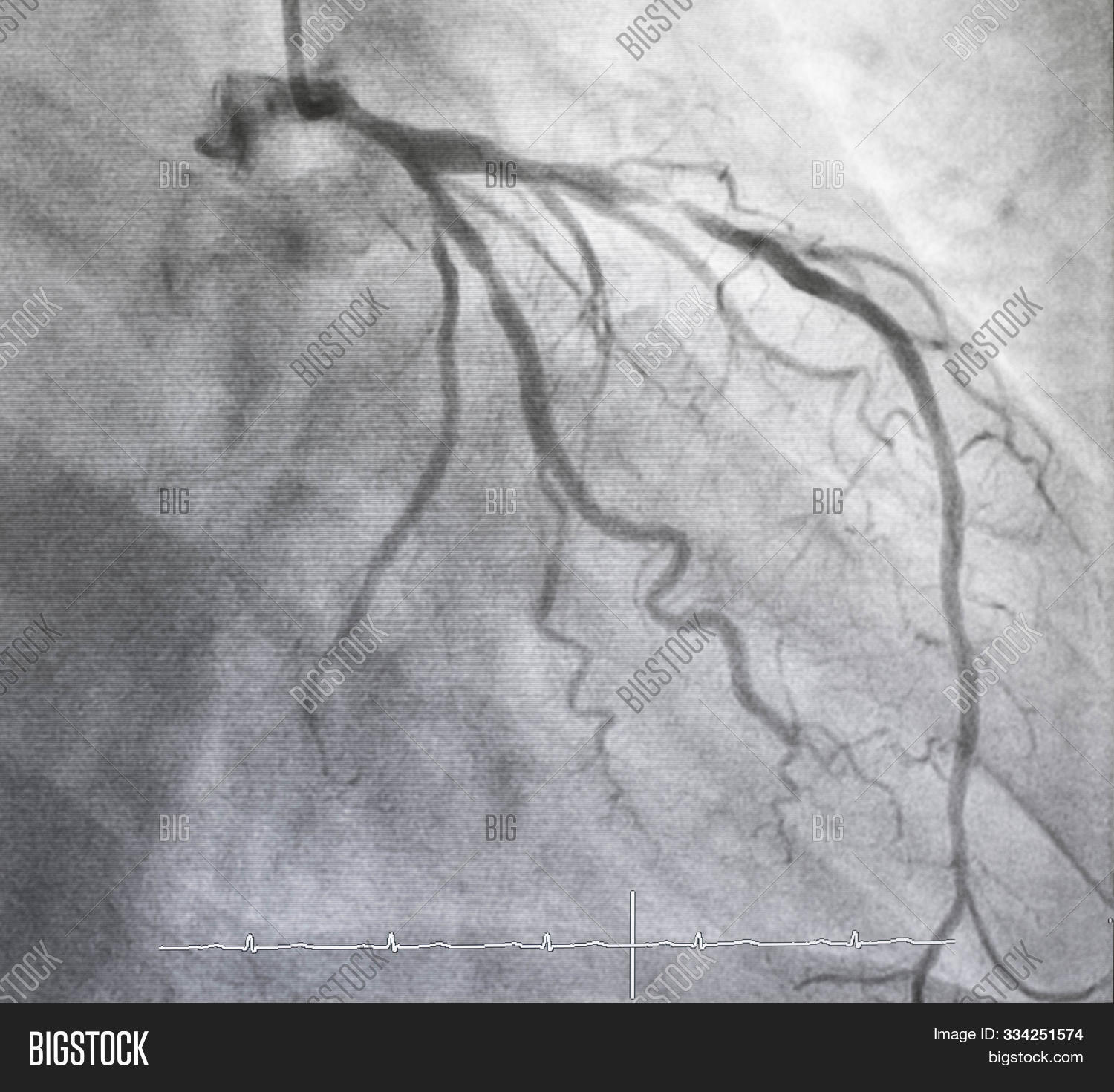 Coronary Angiography , Left Coronary Angiography, Stenosis At Proximal ...