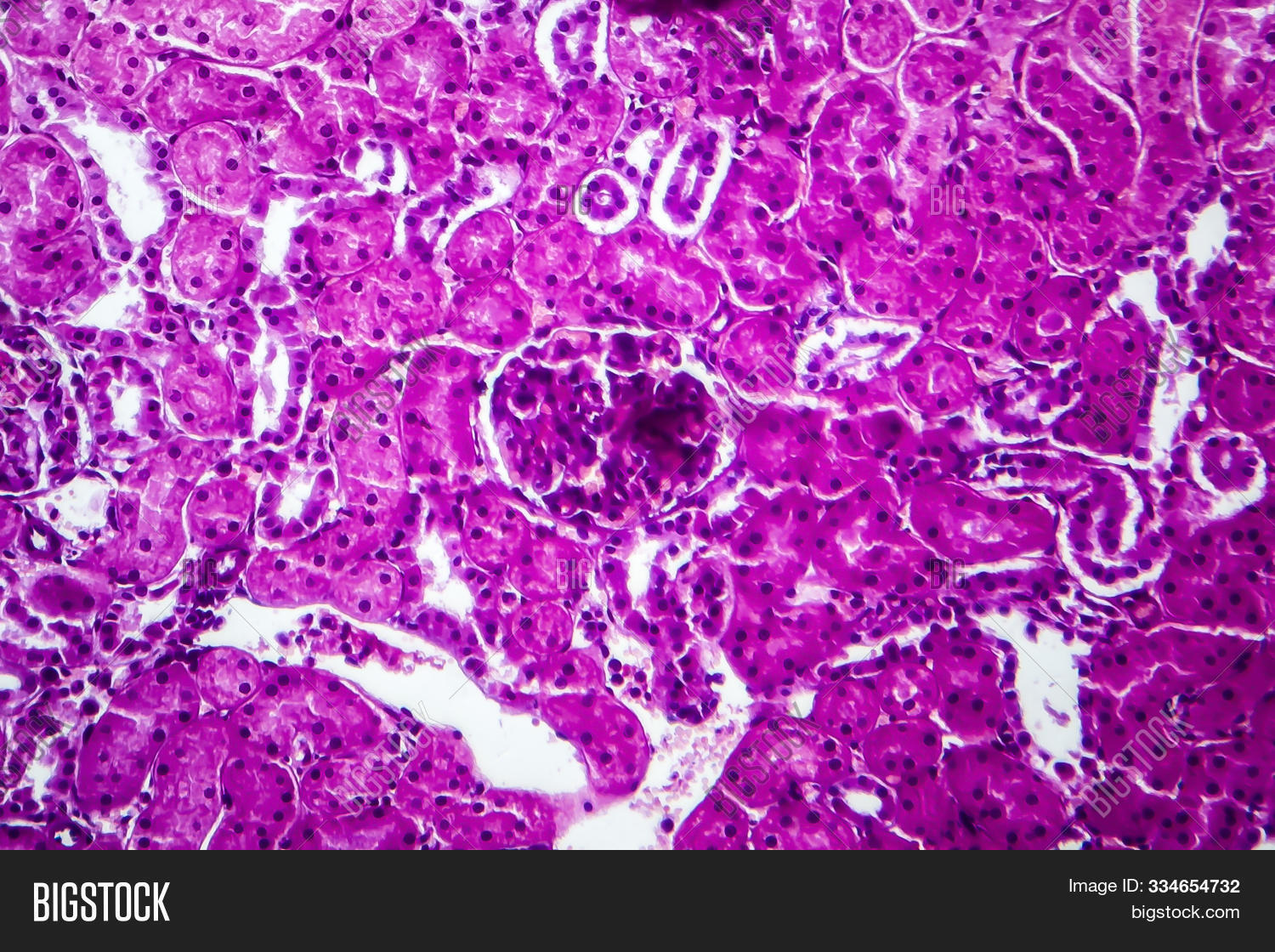 Histopathology Of Acute Nephritis, Light Micrograph, Photo Under ...