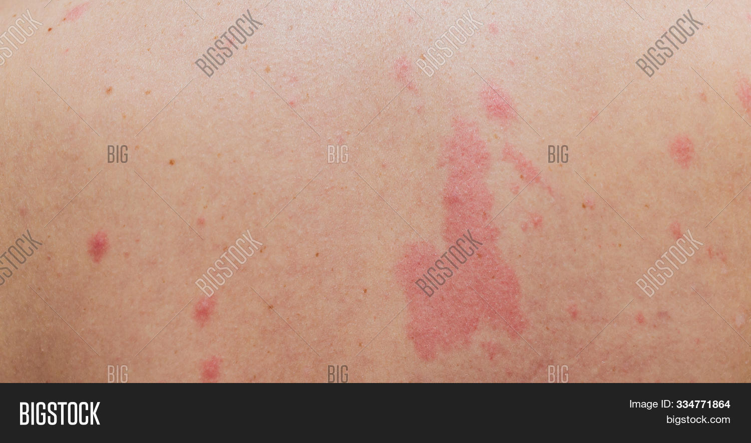 Close Up Allergy Rash, Around Back View Of Human With Dermatitis ...