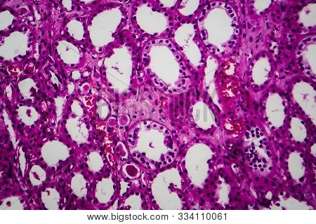 Tubular Atrophy, Light Micrograph, Photo Under Microscope image & stock ...