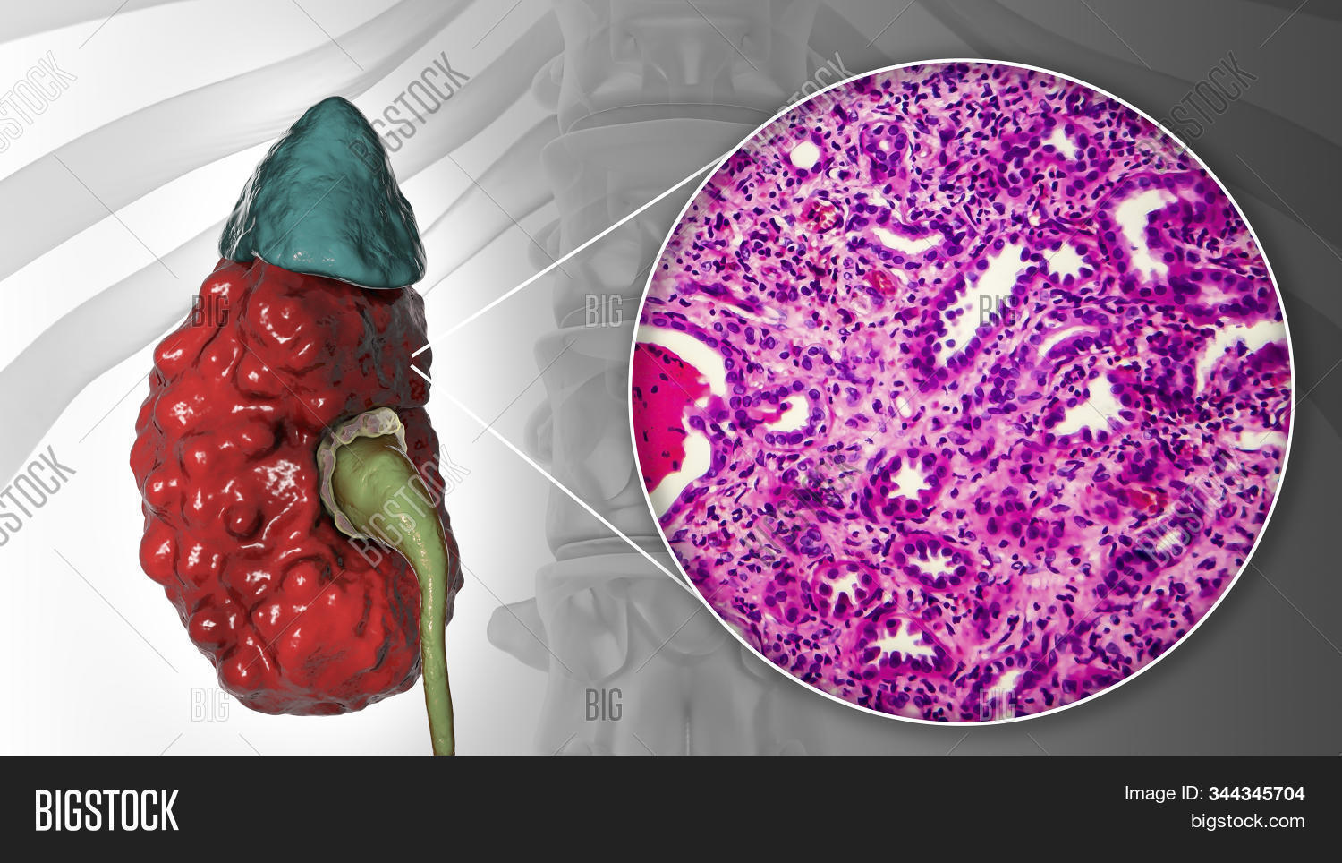 Chronic Pyelonephritis, 3d Illustration Showing Gross Morphology With ...