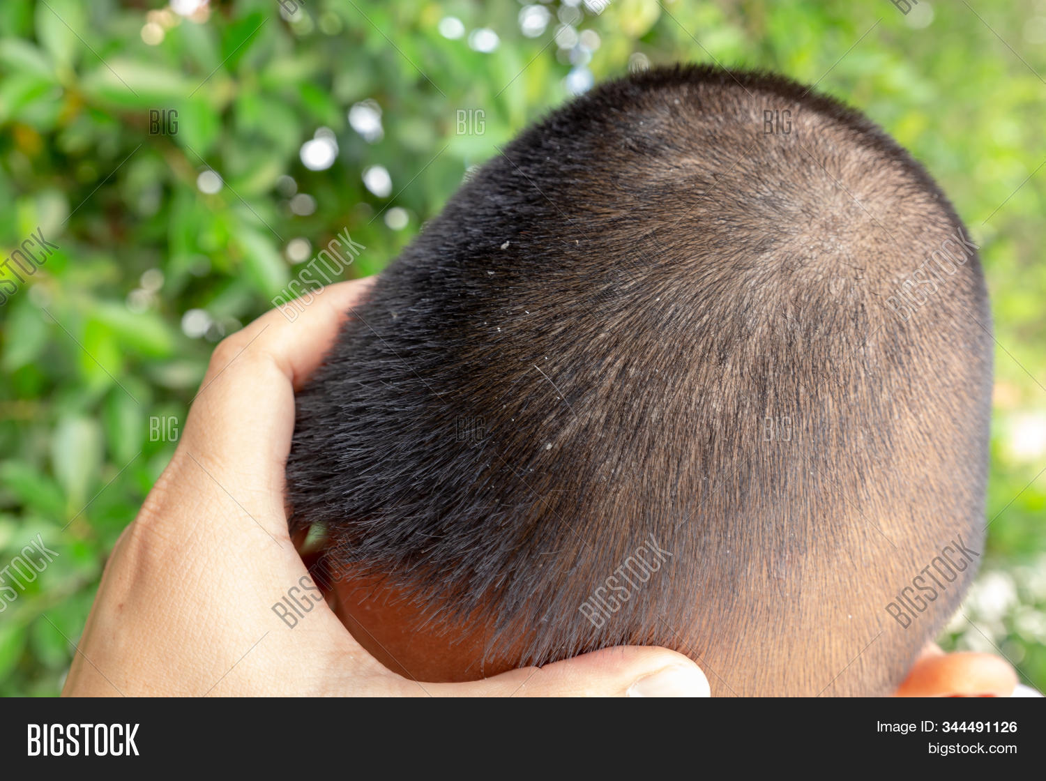 Close-up Skin Head , Scalp, Photos Of Dermatitis And Eczema, Skin ...