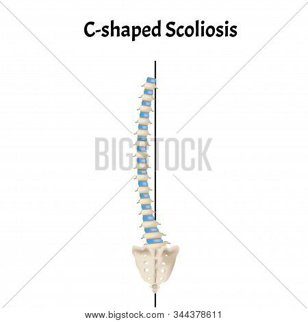 C-shaped Scoliosis. Dextroscoliosis. Levoscoliosis. Spinal Curvature ...