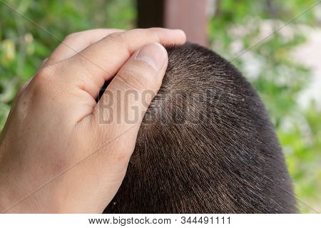 Close-up Skin Head , Scalp, Photos Of Dermatitis And Eczema, Skin ...