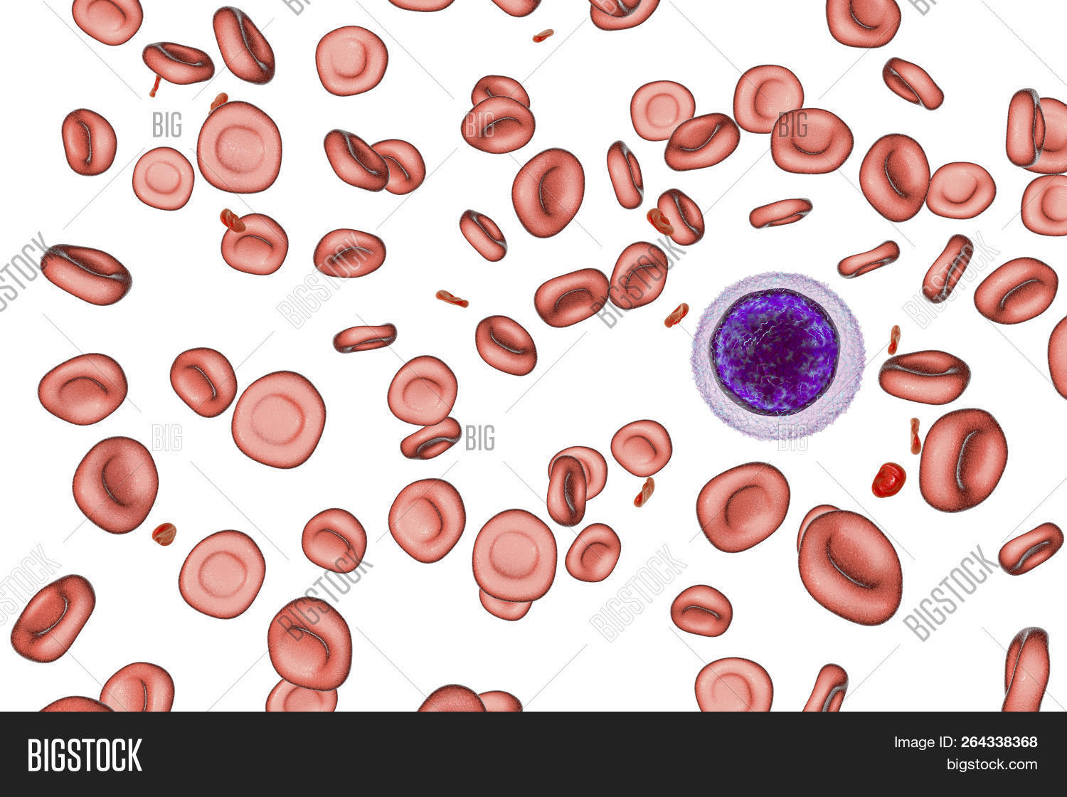 Iron Deficiency Anemia, 3d Illustration Showing Small Hypochromic Red ...