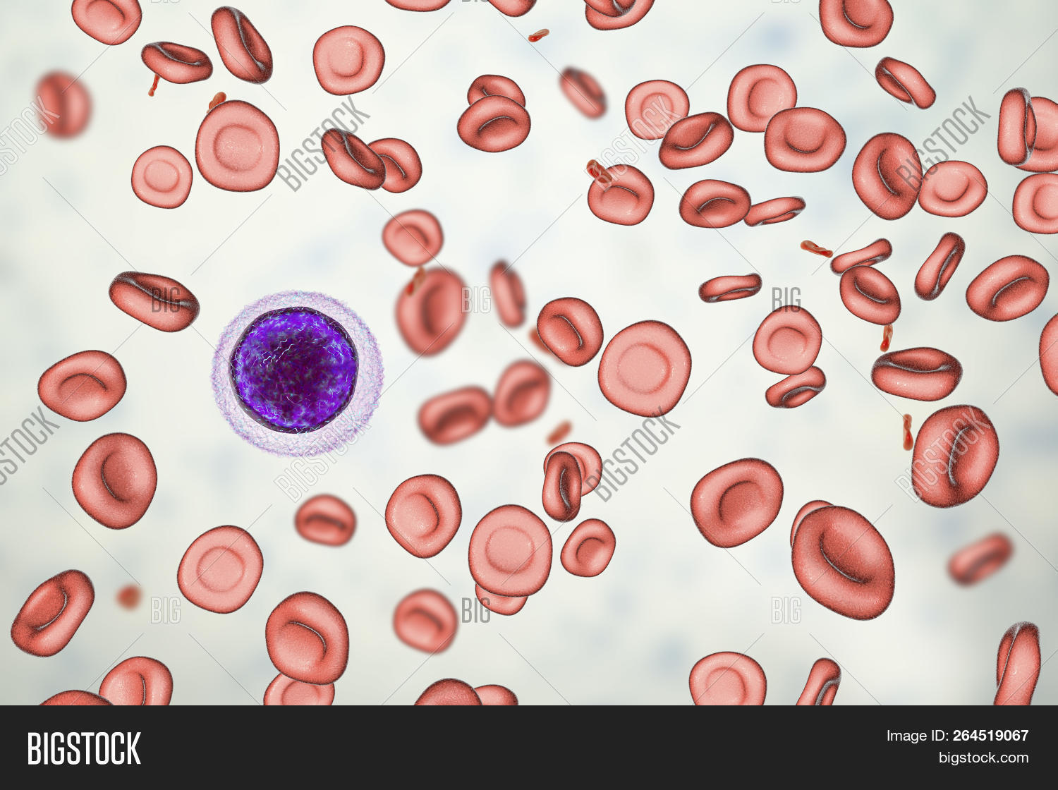 Iron Deficiency Anemia, 3d Illustration Showing Small Hypochromic Red ...