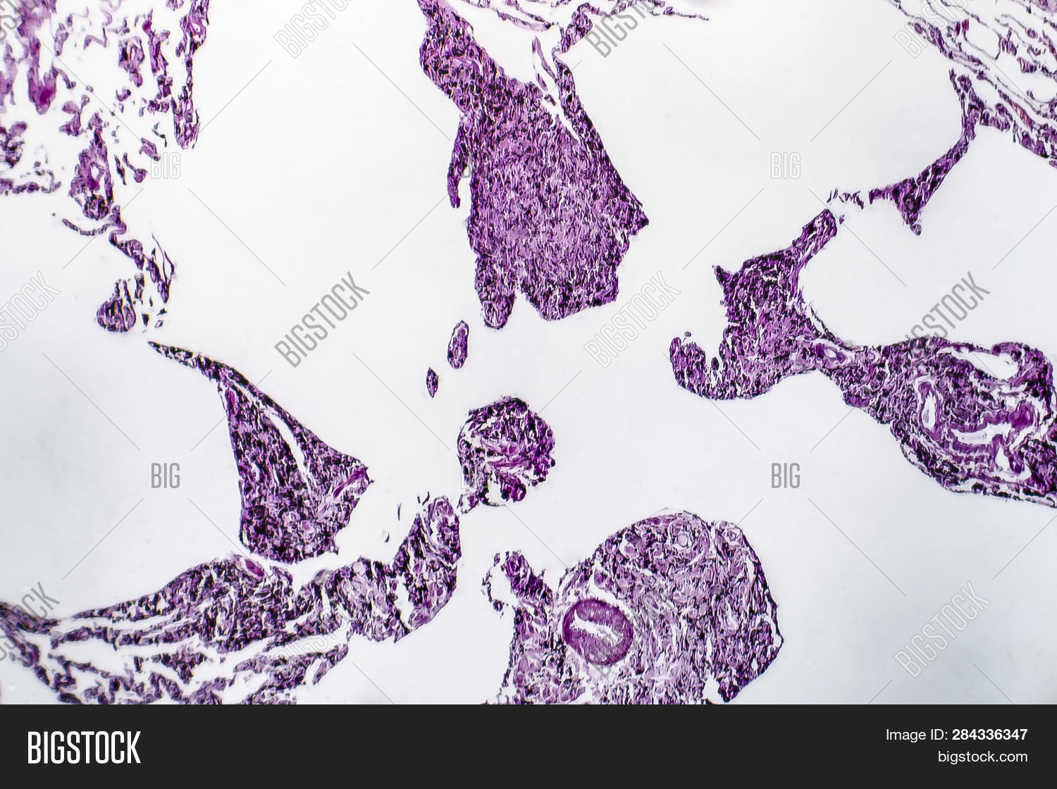 Histopathology Of Lung Emphysema, Light Micrograph, Photo Under ...