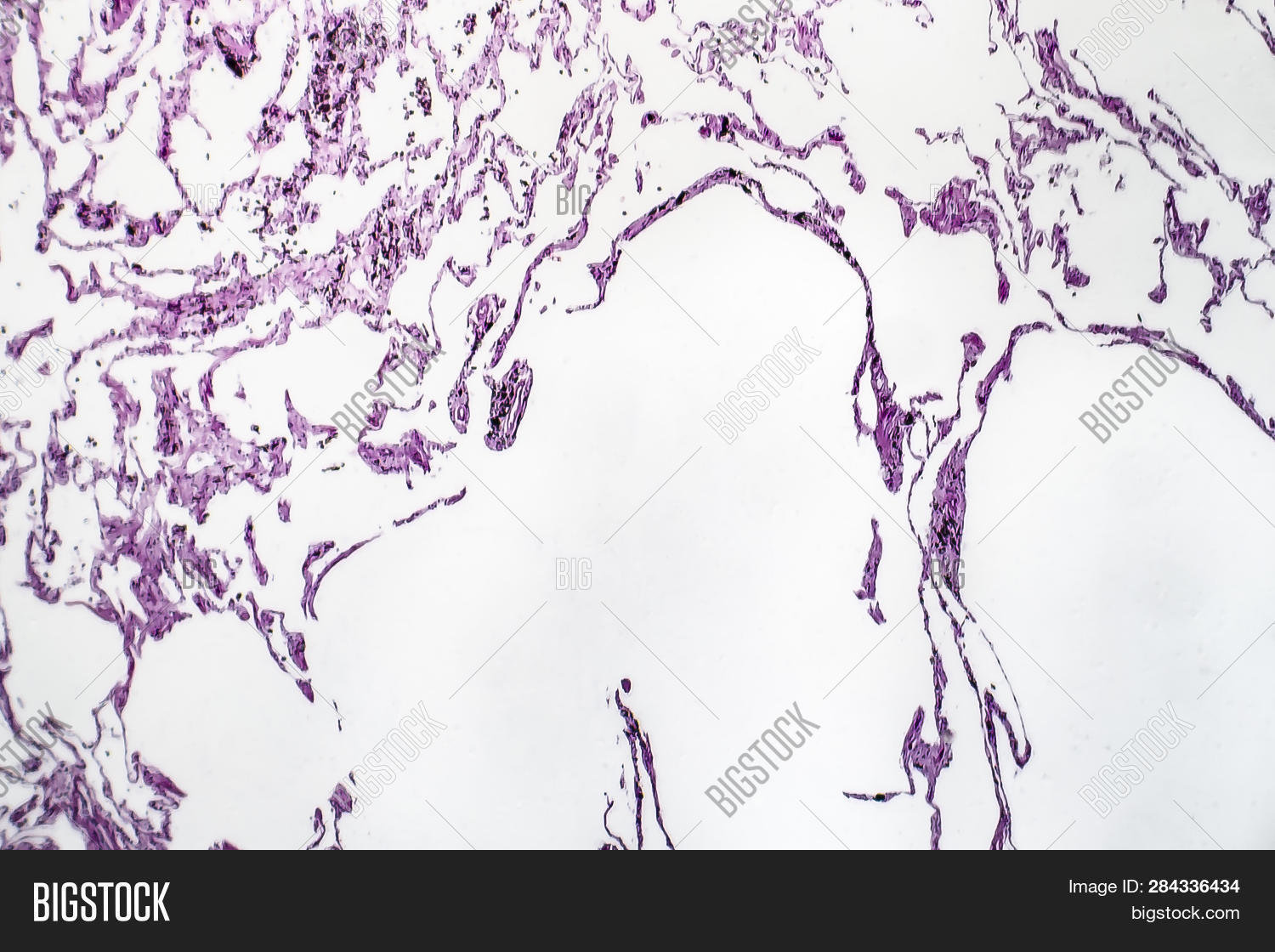 Histopathology Of Lung Emphysema, Light Micrograph, Photo Under ...