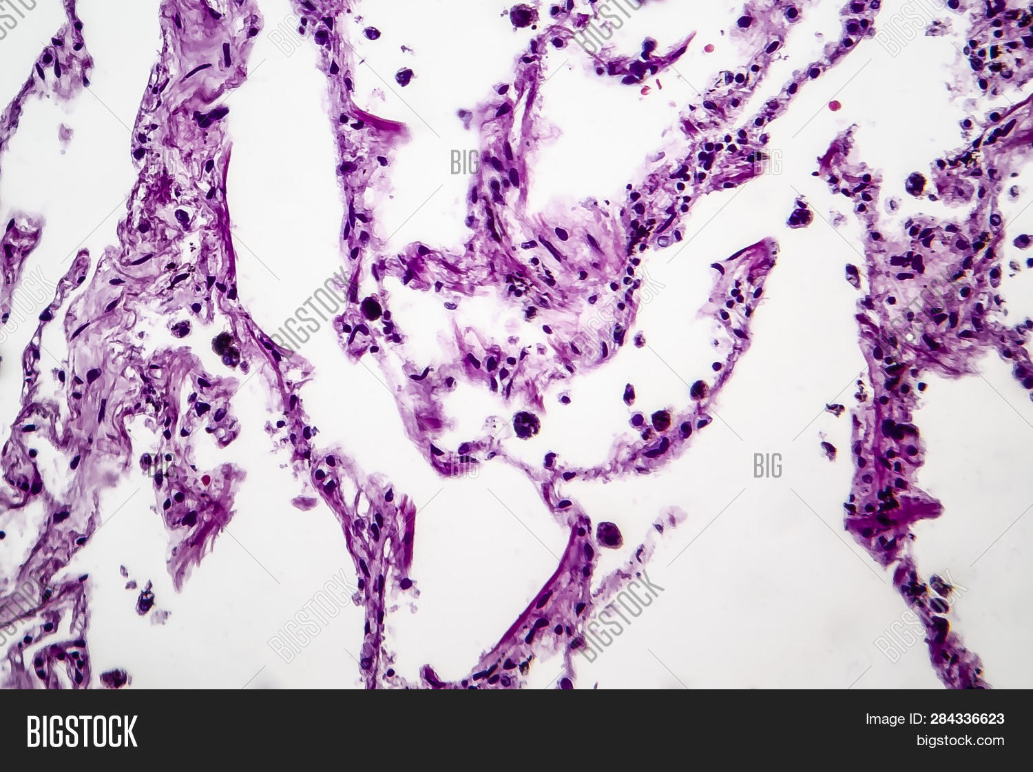 Histopathology Of Lung Emphysema, Light Micrograph, Photo Under ...