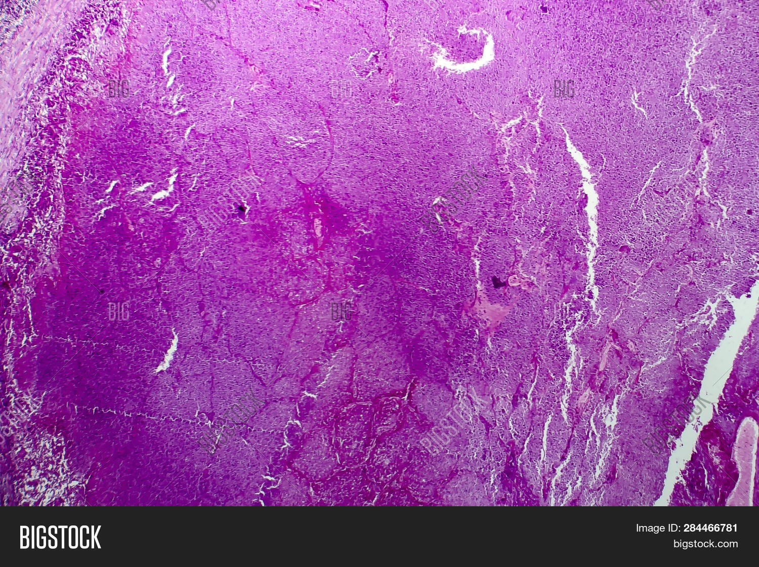 Caseation Of Human Tuberculosis Granuloma, Light Micrograph, Photo ...