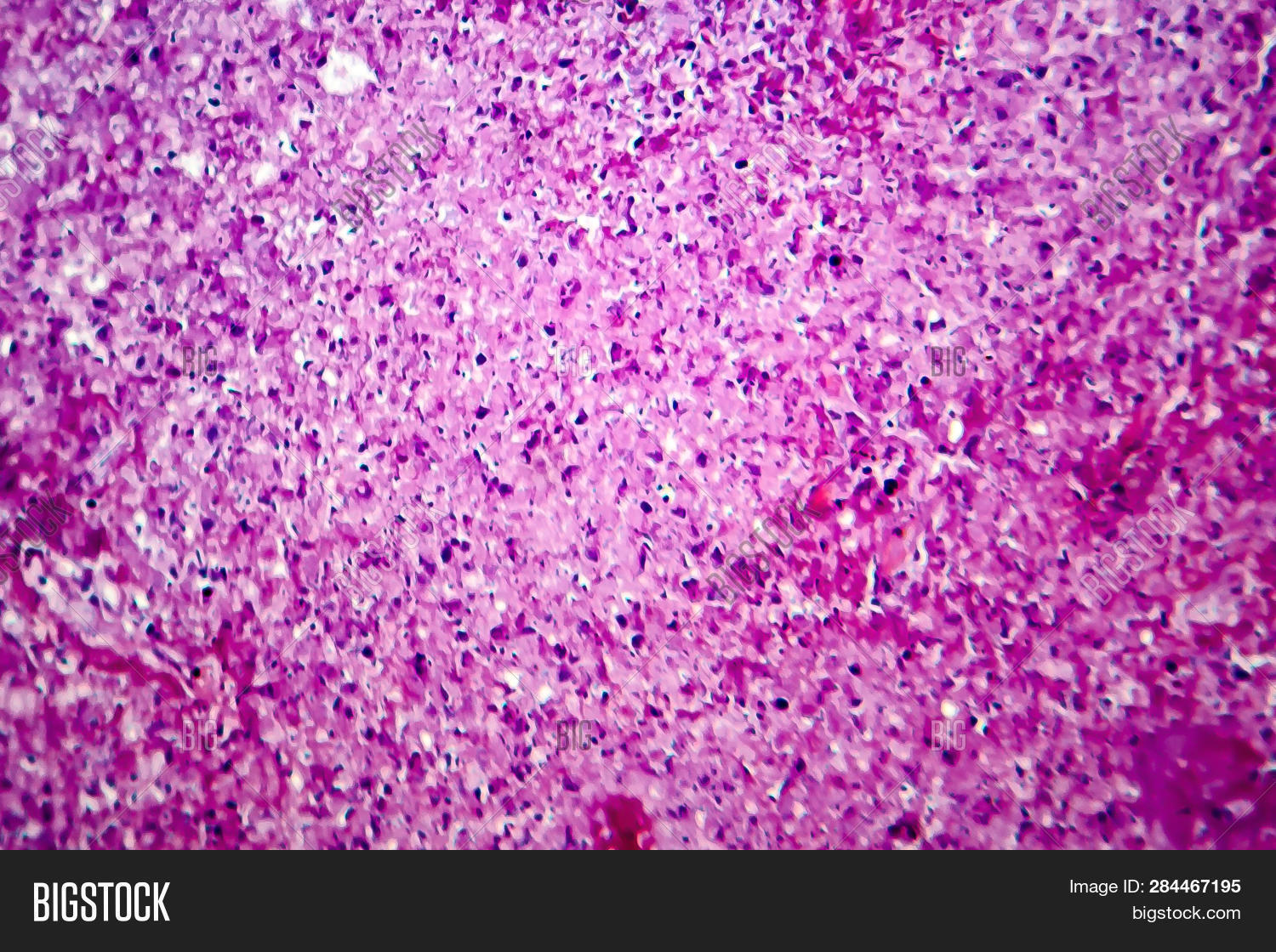 Caseation Of Human Tuberculosis Granuloma, Light Micrograph, Photo ...