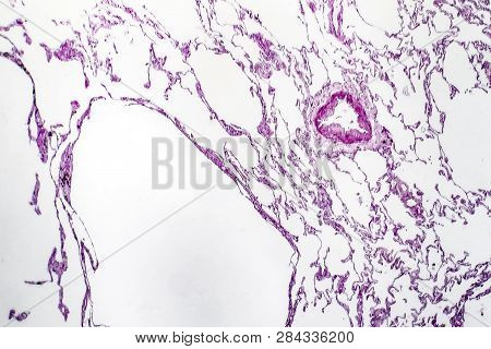 Histopathology Of Lung Emphysema, Light Micrograph, Photo Under ...