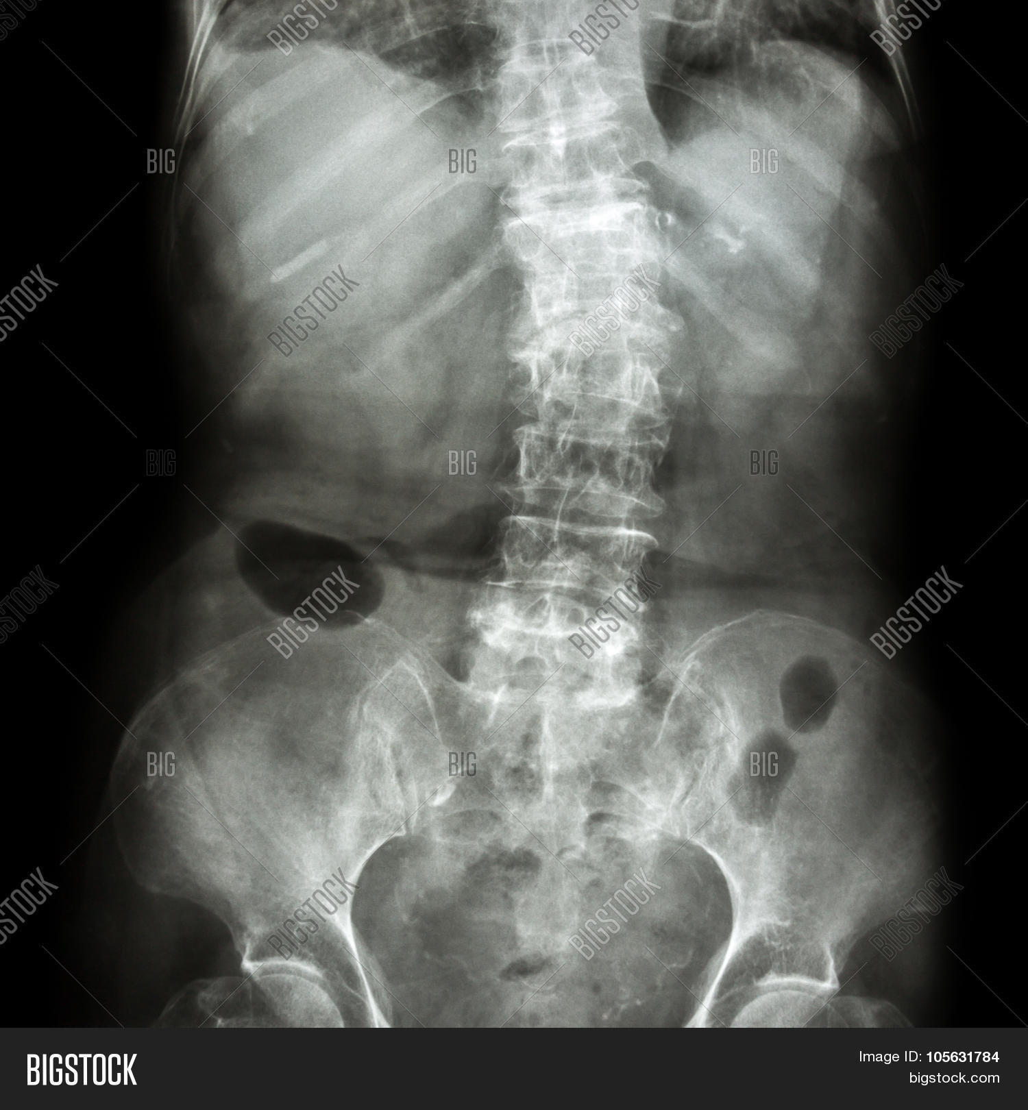 Spondylosis And Scoliosis ( Film X-ray Lumbar - Sacrum Spine Show ...