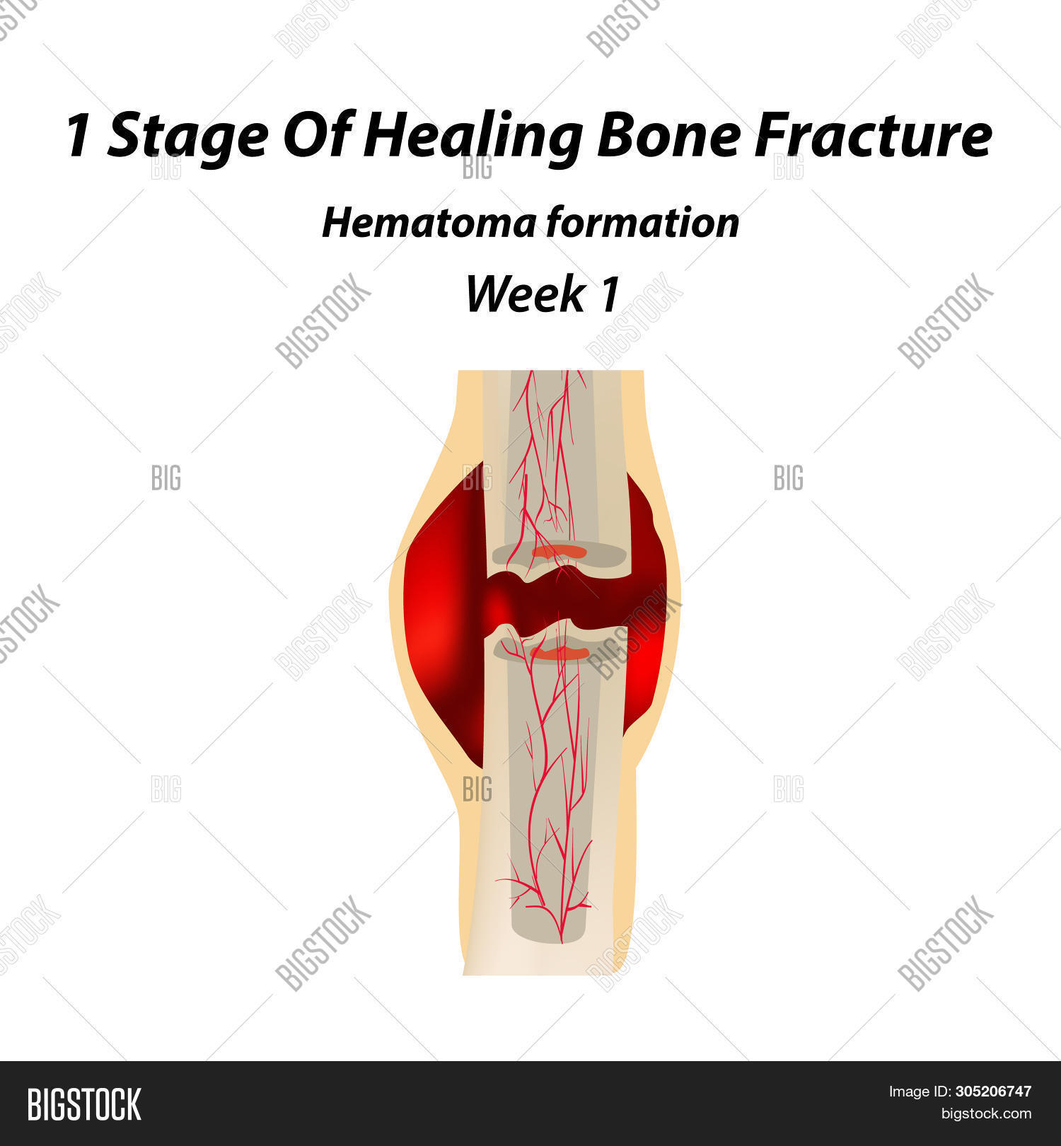 1 Stage Of Healing Bone Fracture. Formation Of Callus. The Bone ...