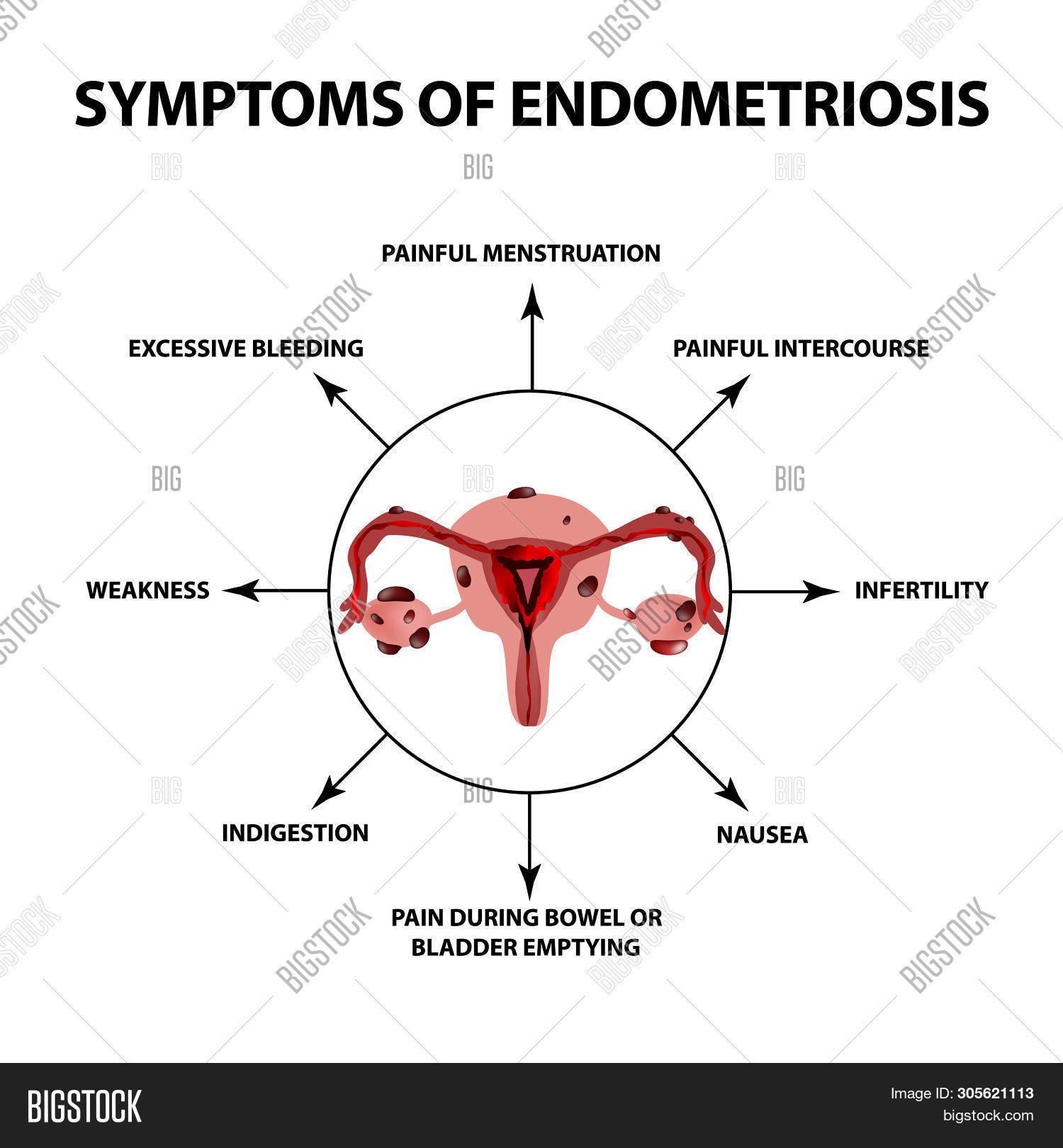 Symptoms Of Endometriosis. The Uterus Ovaries Structure. Infographics ...