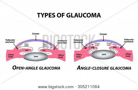 Types Of Glaucoma. Open-angle And Angle-closure Glaucoma. The ...