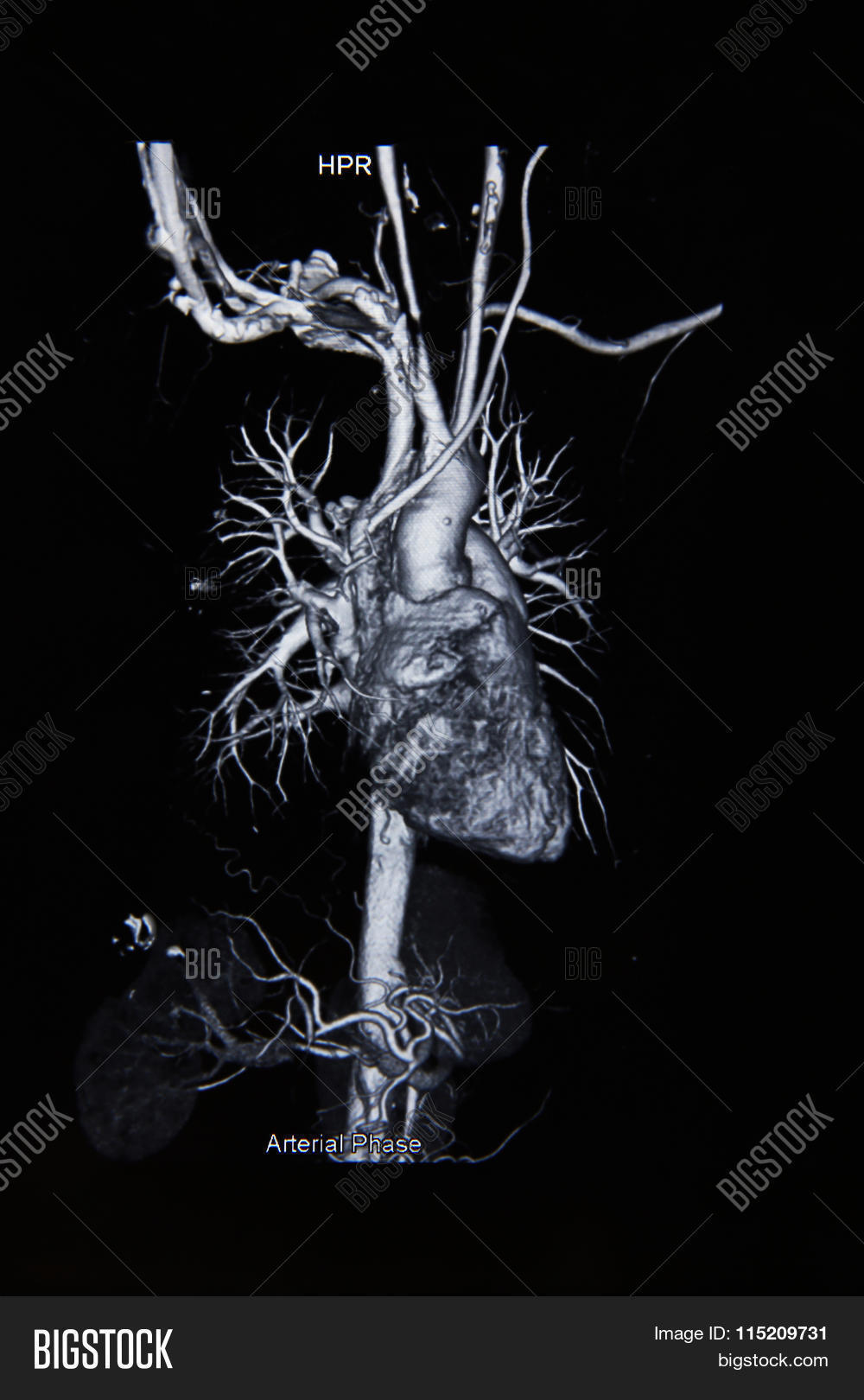 Ct Scan Angiogram (take Photo From Film X-ray) image & stock photo ...