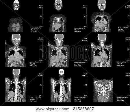 Ct Scan Abdomen,chest And Front View Body By Mri Scan. Medical ...