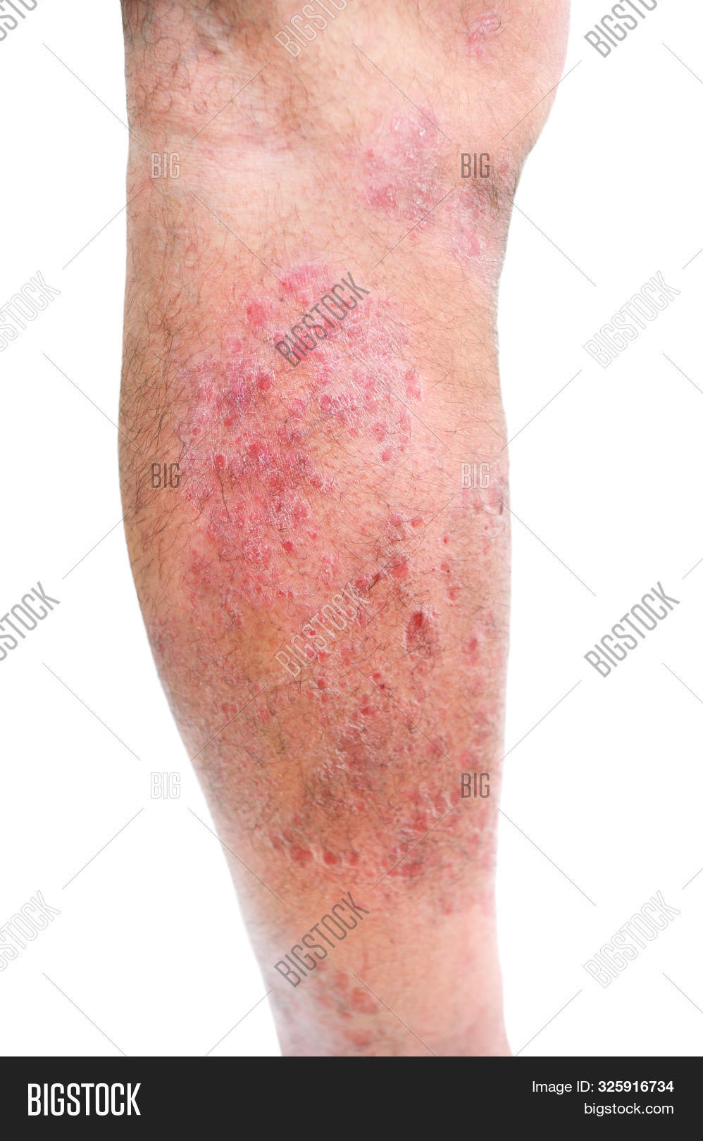 Atopic dermatitis (AD), also known as atopic eczema, is a type of skin ...