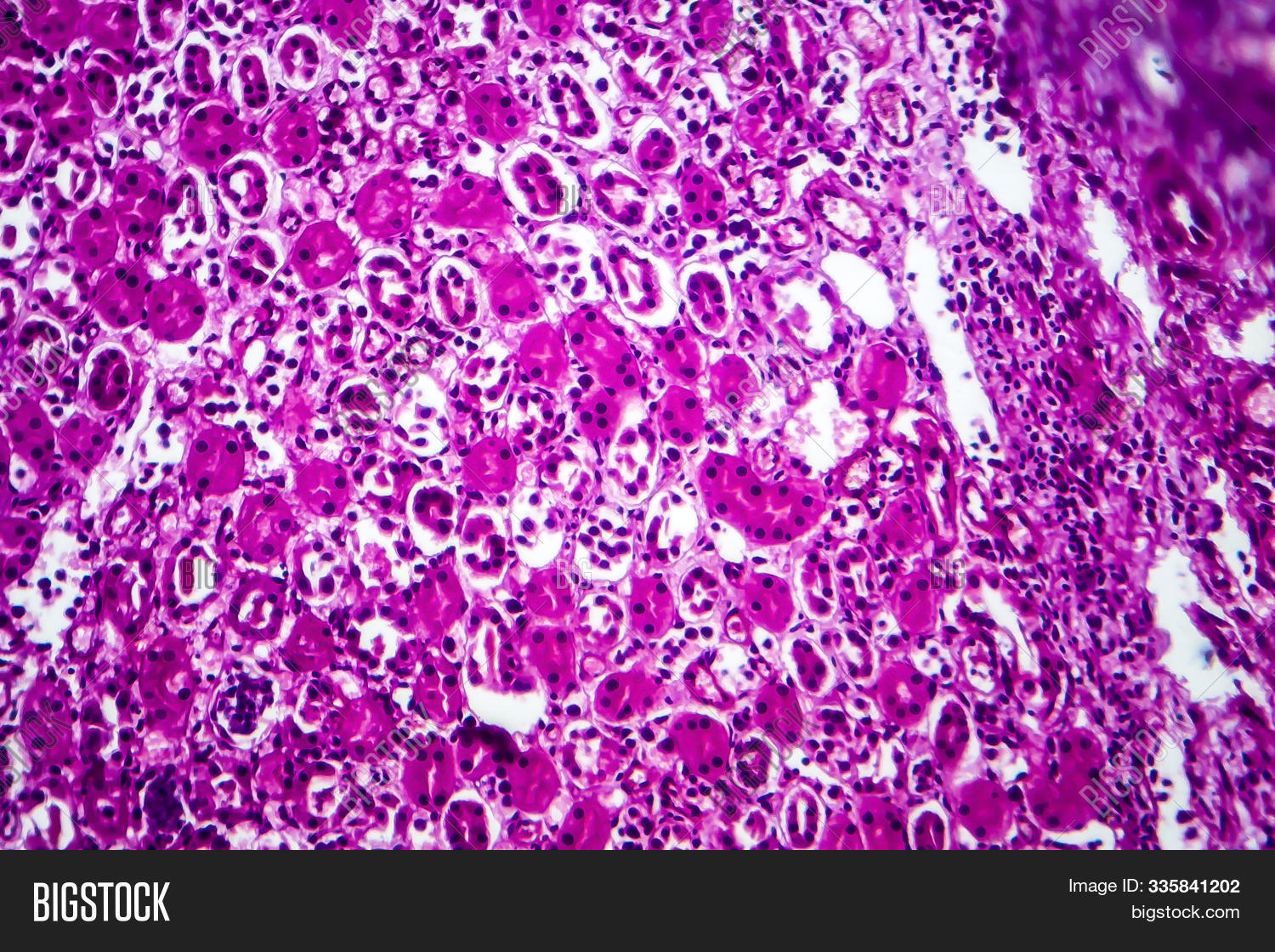 Histopathology Of Acute Nephritis, Light Micrograph, Photo Under ...