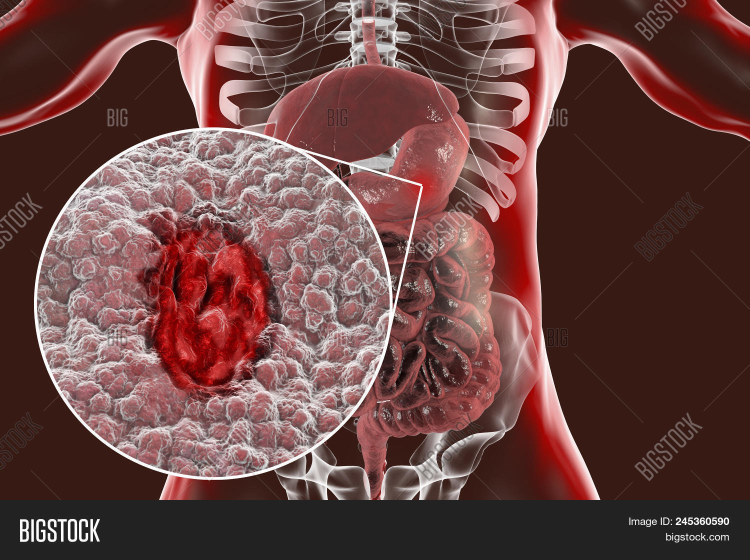 Gastric Ulcer. Mucosa Of Stomach With Ulcer And Anatomy Of Human ...