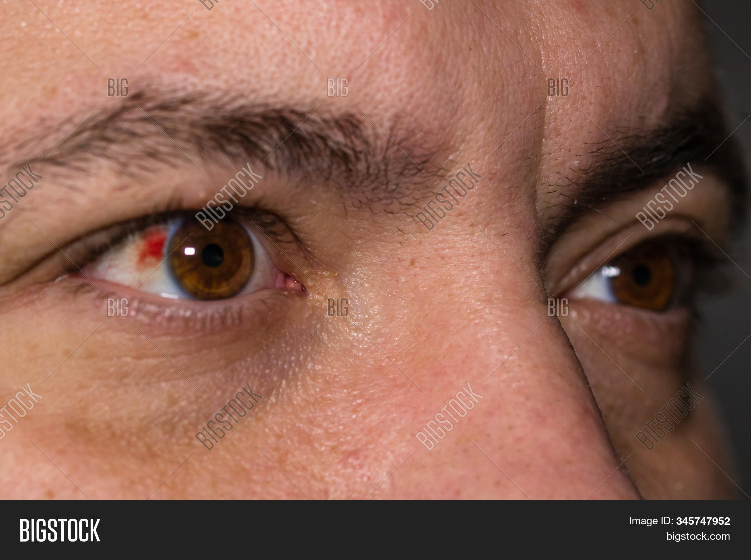 Eye Injury, Young Man With Burst Blood Vessel In Eye, Fatigue, Problems ...