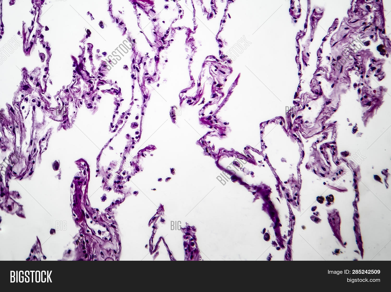 Histopathology Of Lung Emphysema, Light Micrograph, Photo Under ...