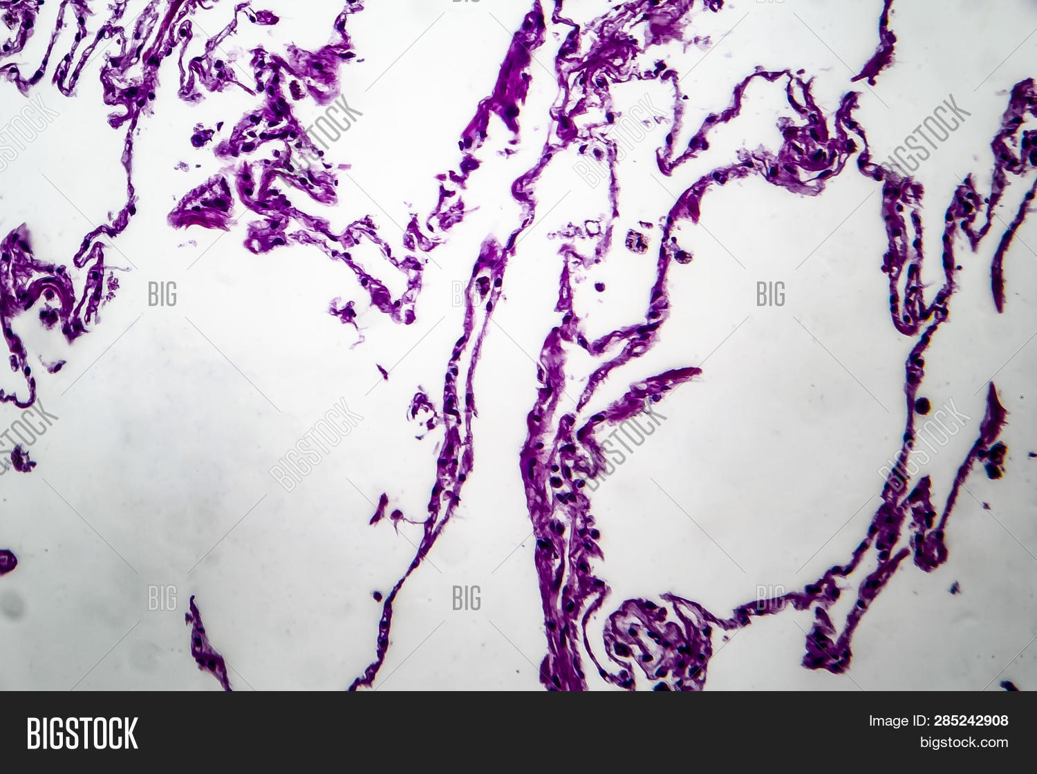 Histopathology Of Lung Emphysema, Light Micrograph, Photo Under ...