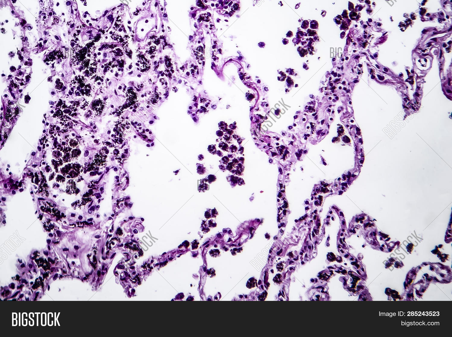 Histopathology Of Lung Emphysema, Light Micrograph, Photo Under ...