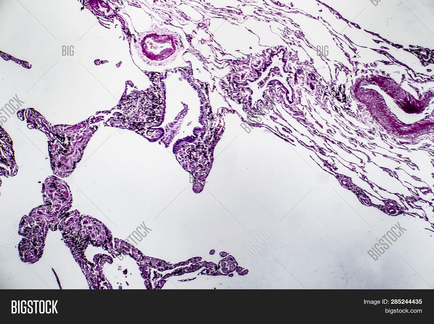 Histopathology Of Lung Emphysema, Light Micrograph, Photo Under ...