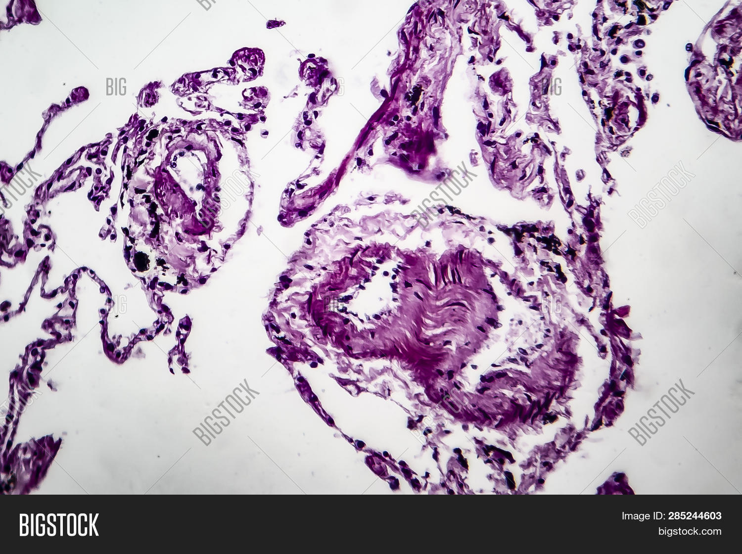 Histopathology Of Lung Emphysema, Light Micrograph, Photo Under ...