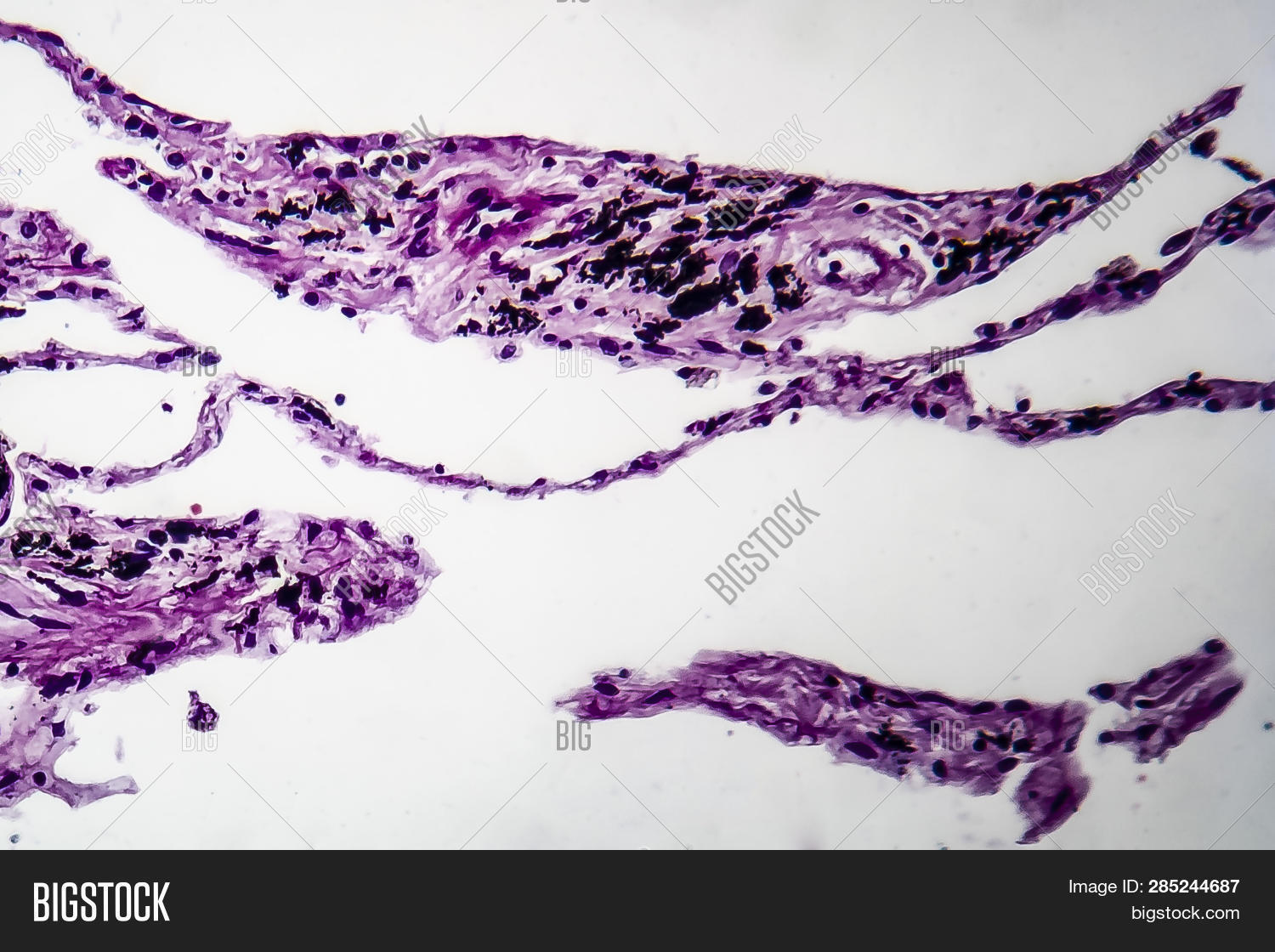 Histopathology Of Lung Emphysema, Light Micrograph, Photo Under ...