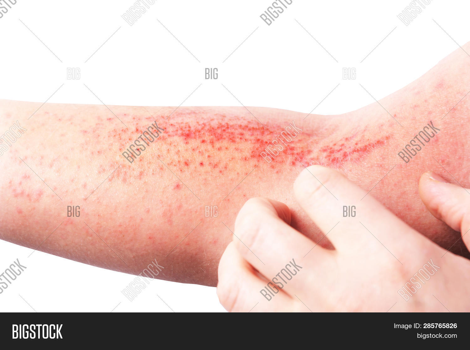 Atopic Dermatitis (ad), Also Known As Atopic Eczema, Is A Type Of ...