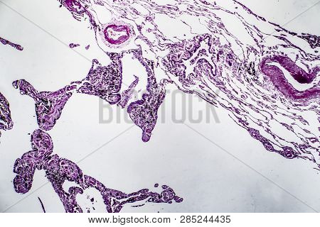 Histopathology Of Lung Emphysema, Light Micrograph, Photo Under ...