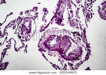 Histopathology Of Lung Emphysema, Light Micrograph, Photo Under ...