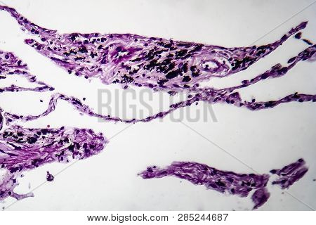 Histopathology Of Lung Emphysema, Light Micrograph, Photo Under ...