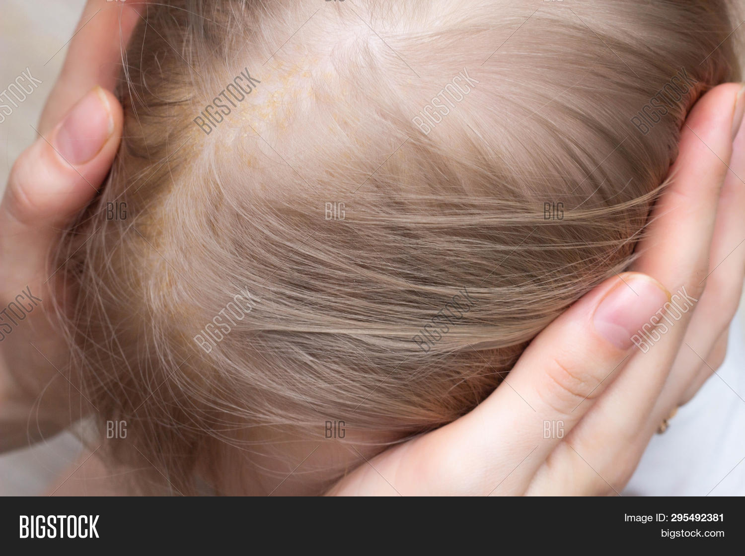 Fungal Skin Disease Seborrheic Dermatitis In A Childs Head, Close-up ...