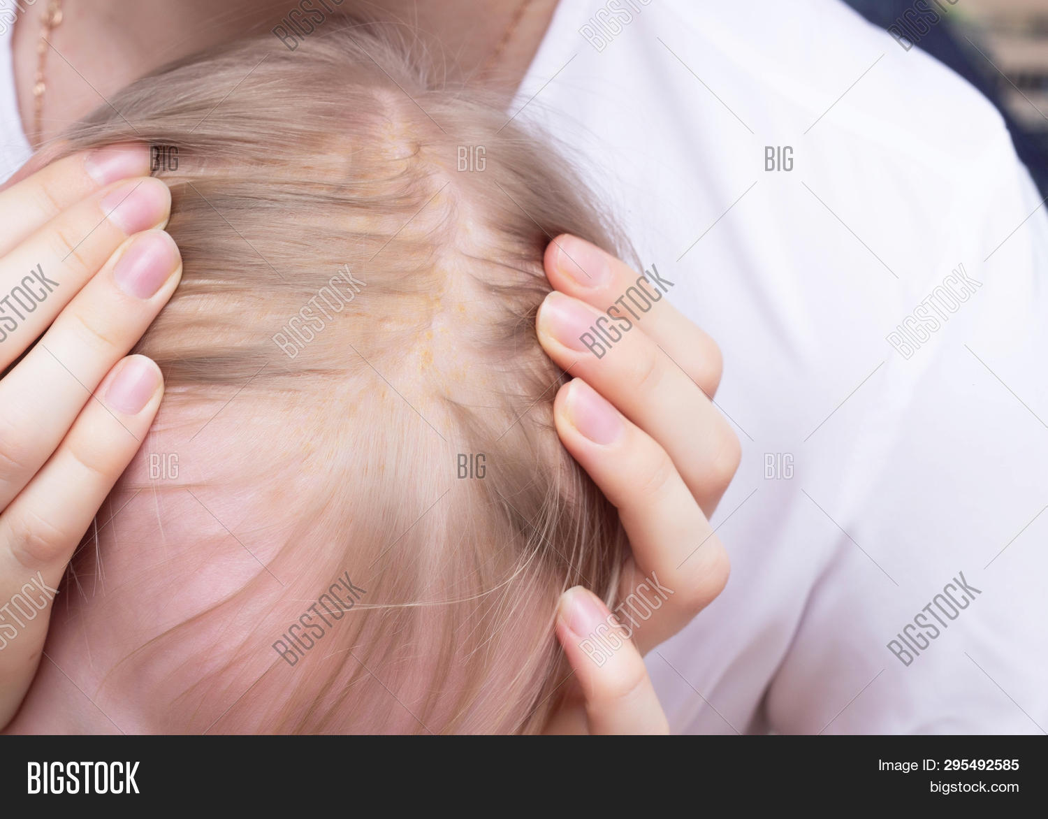 Fungal Skin Disease Seborrheic Dermatitis In A Childs Head, Close-up ...